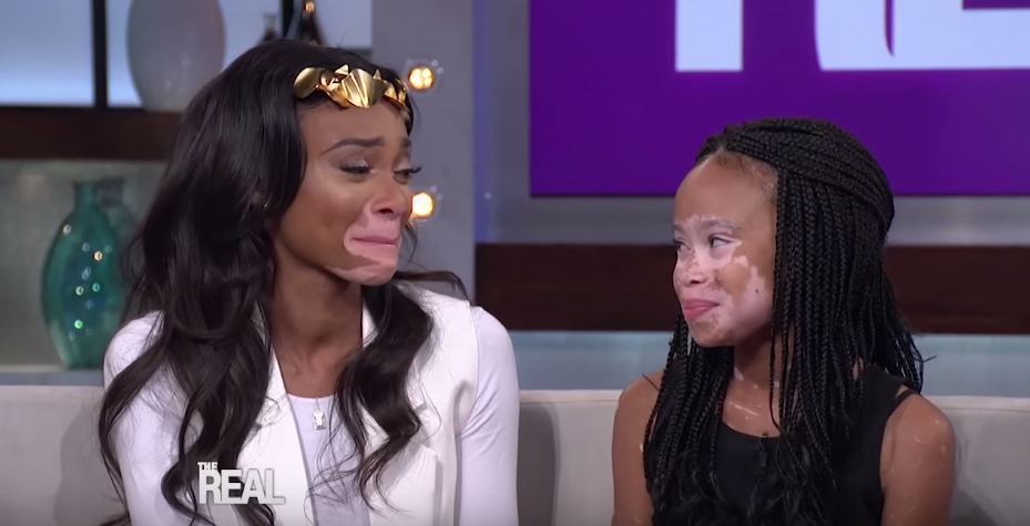 10yearold With Vitiligo Becomes An Instagram Star