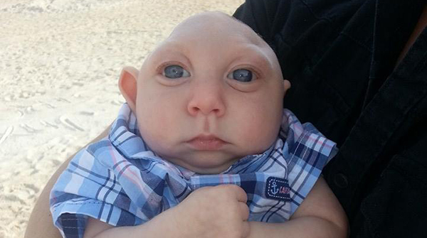 Jaxon Strong: How Boy Born With a Partial Skull Proved Doctors Wrong ...