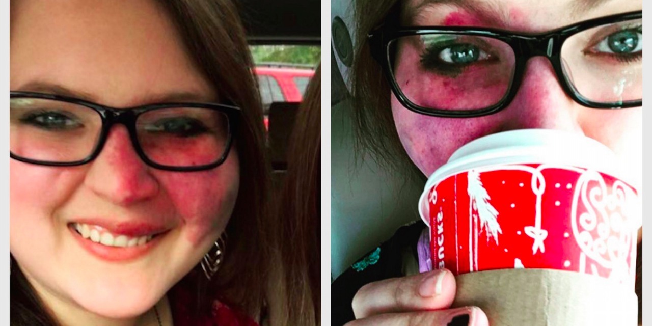 Port-Wine Stain Birthmark: Why I Love the Birthmark on My Face | The Mighty