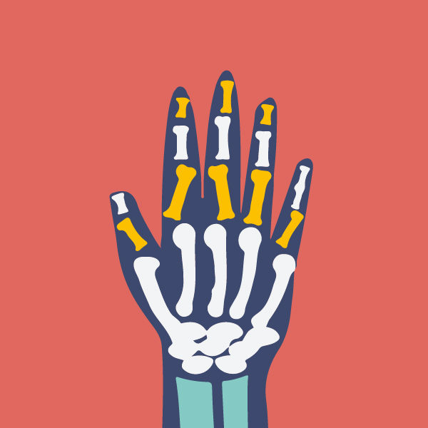 Rheumatoid Arthritis | Signs, Symptoms, Support