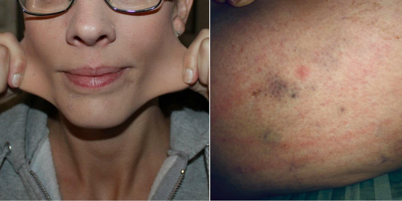 23 Photos That Show How Ehlers Danlos Syndrome Affects The Skin 23 Photos That Show How Ehlers Danlos Syndrome Affects The Skin