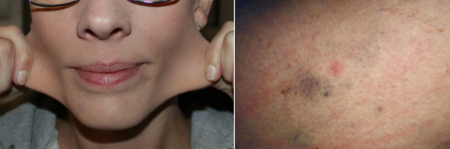23 Photos That Show How Ehlers-Danlos Syndrome Affects the Skin