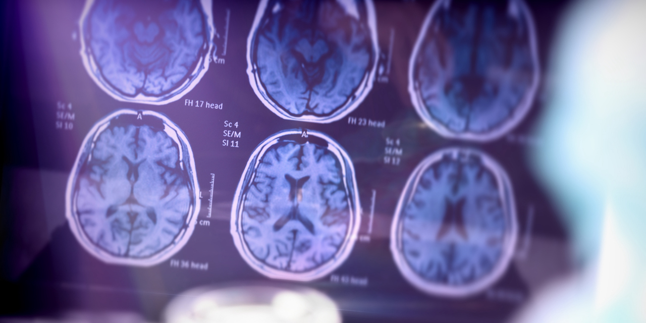 The Neuroscience Behind Anorexia