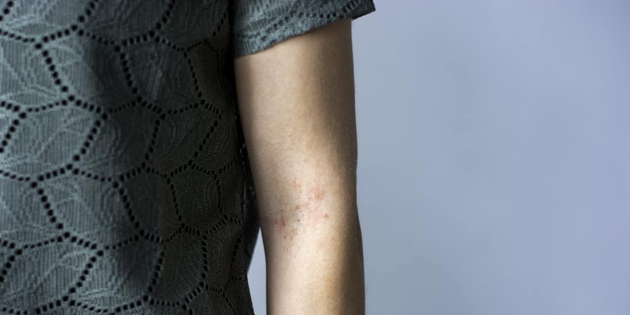 What is Alagille Syndrome With Cholestatic Pruritus?